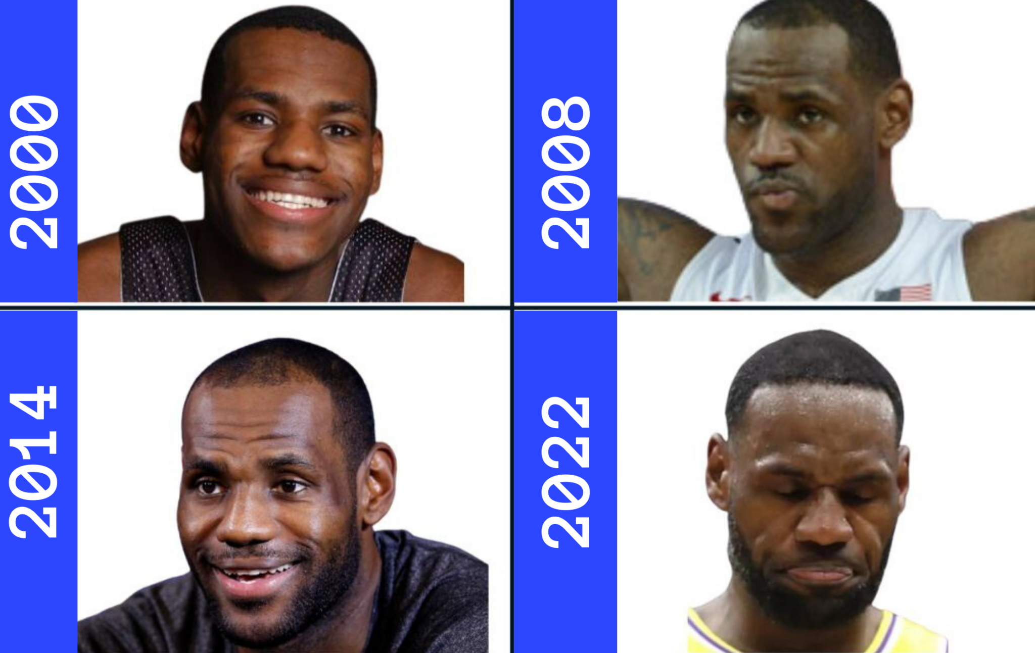 Lebron James Hair Transplant: From Receding to Rebounding
