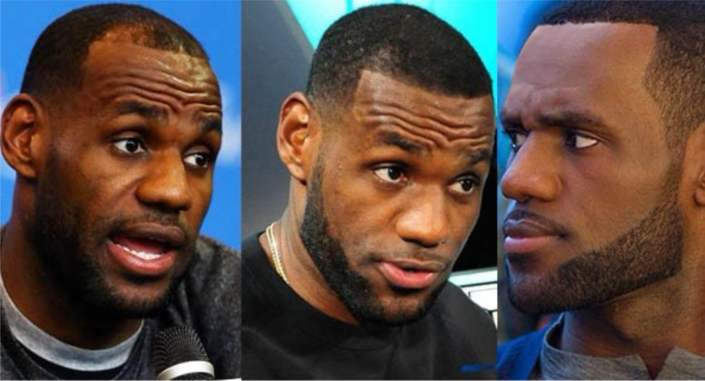 Lebron James Hair Transplant: From Receding to Rebounding